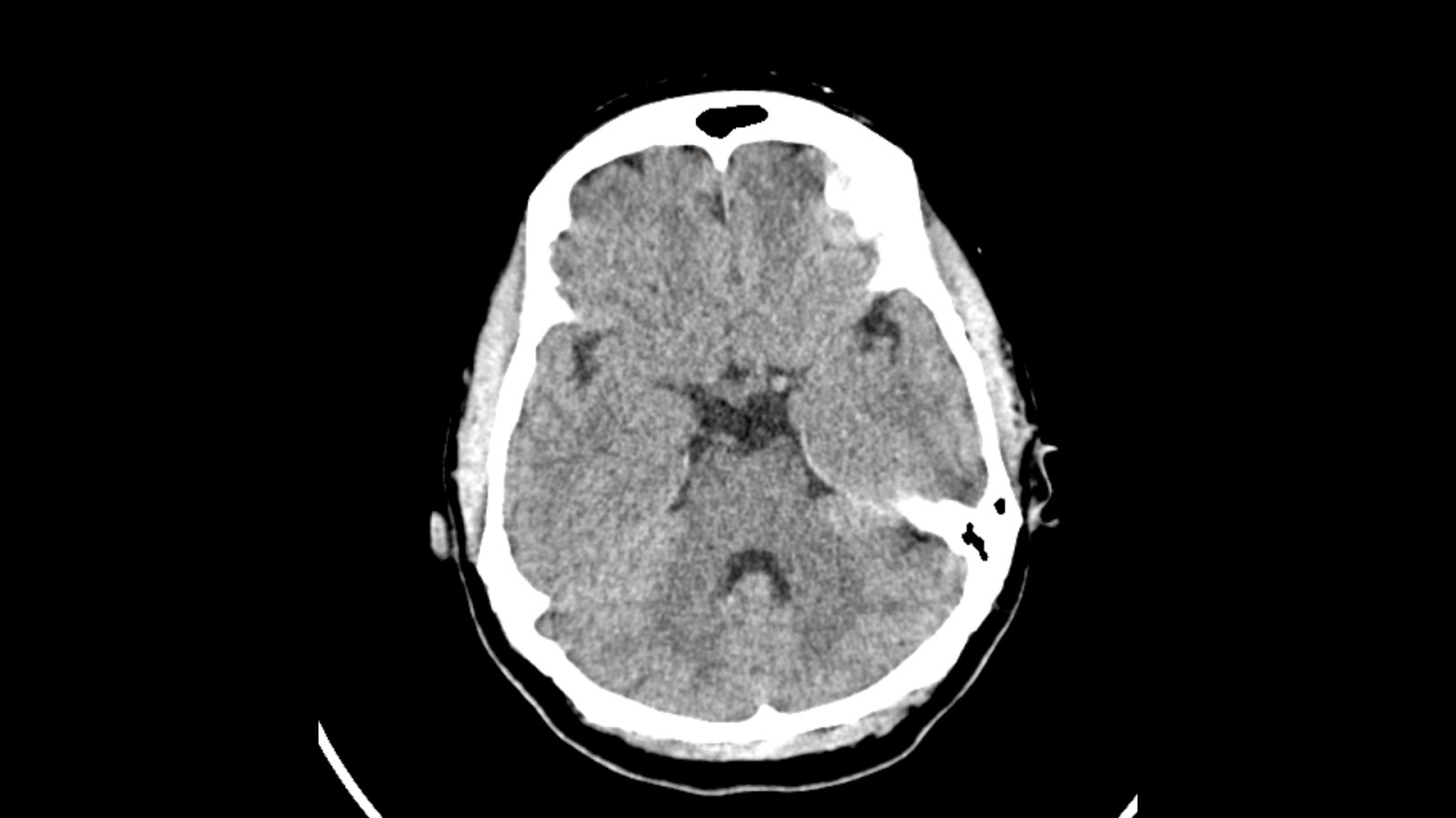 Ultimate Radiology : Fetal PCA
