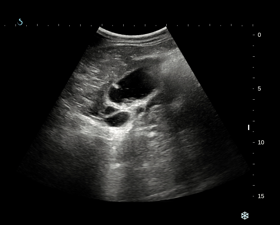 VIETNAMESE MEDIC ULTRASOUND: CASE 344 :LEFT GROIN TUMOR, Dr PHAN THANH ...