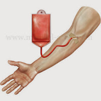 18 Cara Prosedur Transfusi Trombosit atau Frozen Plasma (FFP) - Tips ...