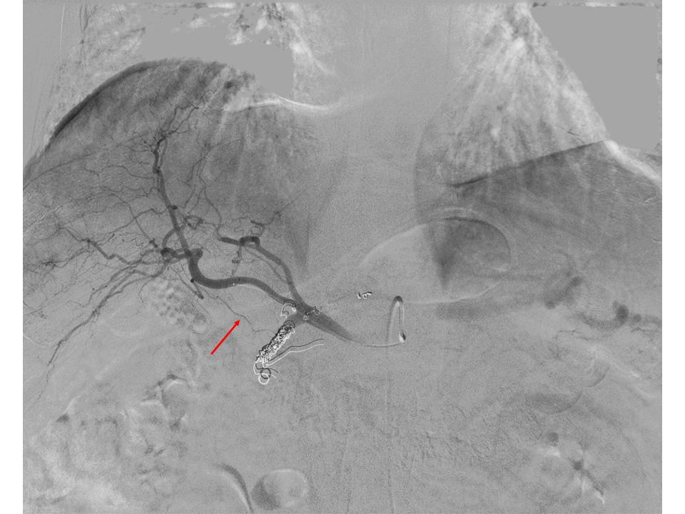 The Pump and the Tubes: The Retroportal Artery