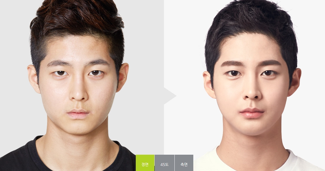 Bệnh Viện Thẩm Mỹ TL Hàn Quốc: [Facial contouring] Men's Plastic ...