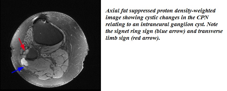 MRI Musculo-Skeletal Section: Common Peroneal Nerve Abnormalities
