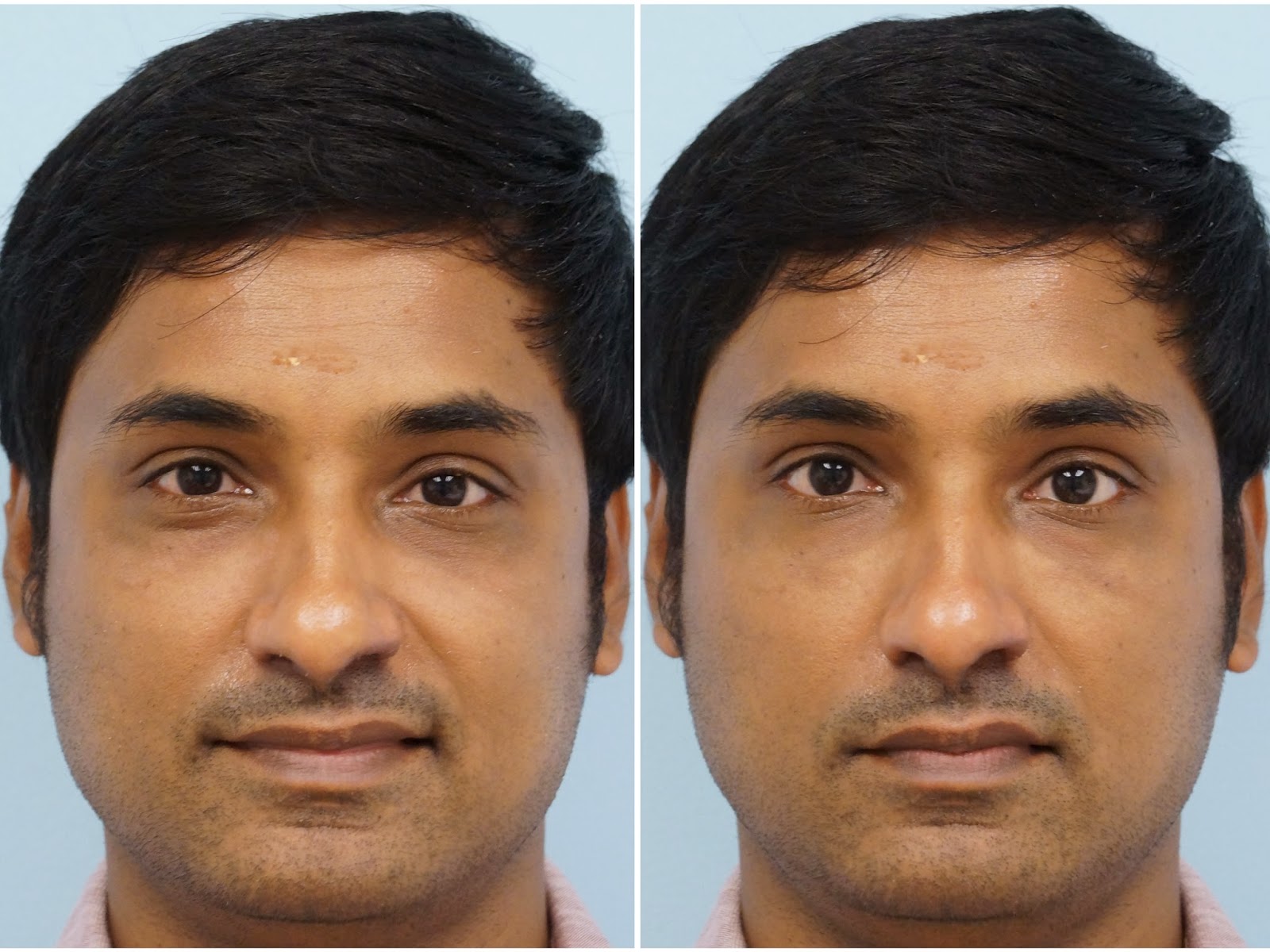Facial Plastic Surgery: Dark undereye shadow, Tear trough filler ...