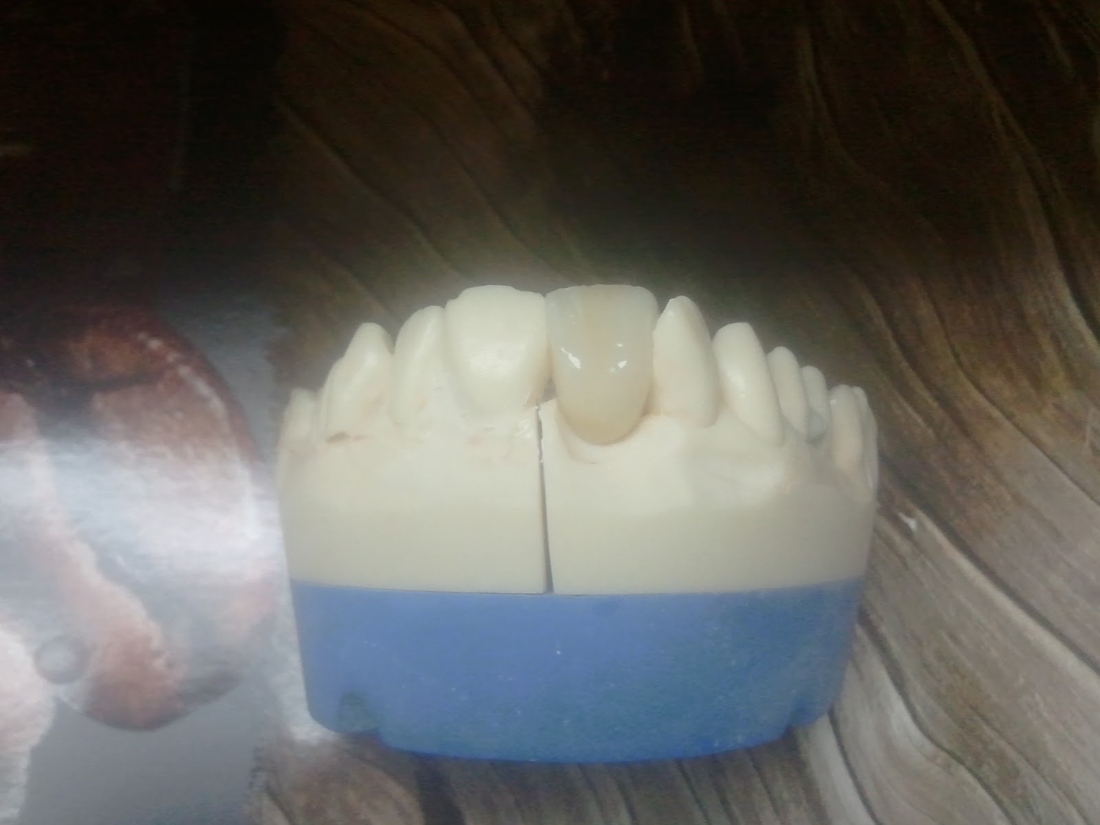 prothèse dentaire le BLOG " Tremel Pascal ": Réalisation d'une centrale ...