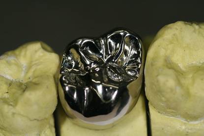 Prótese Dentária Figueiredo: Restaurações Metálicas