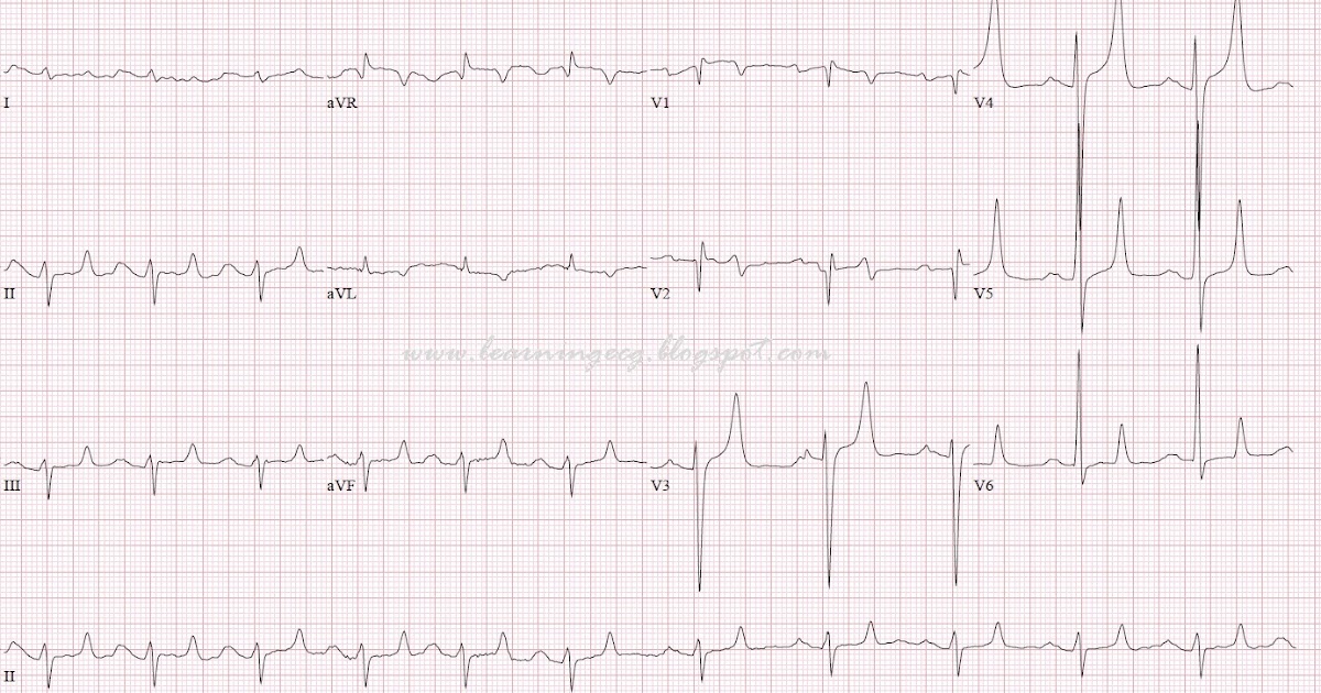 ECG Rhythms: Tented T waves of Hyperkalemia