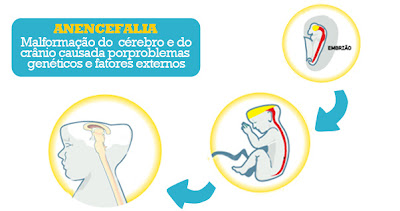 Dr. Aramis Pedro Teixeira: Anencefalia