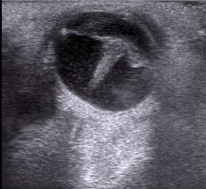 Persistent Hyperplastic Primary Vitreous : Case Report - Sumer's ...