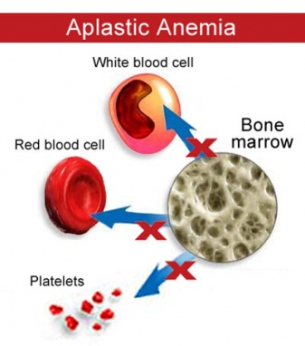 Types Of Anemia - The Secret Recipe of Our Body