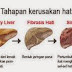 Macam-Macam Penyakit Hati Fisik