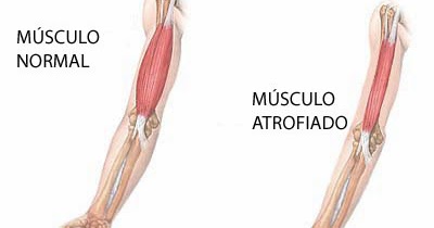 ¿Cómo se sabe si se padece distrofia muscular?