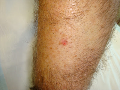 Consultations in Dermatoscopy: Blues revisited and a leg lesion