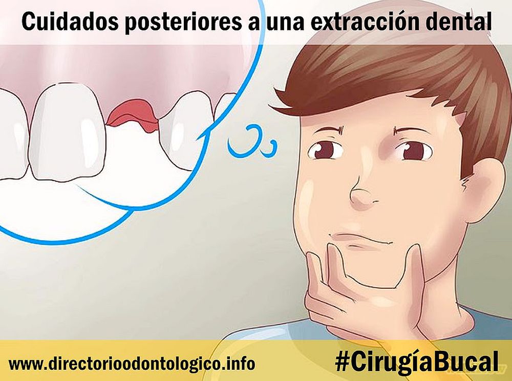 CIRUGÍA BUCAL: Cuidados posteriores a una extracción dental
