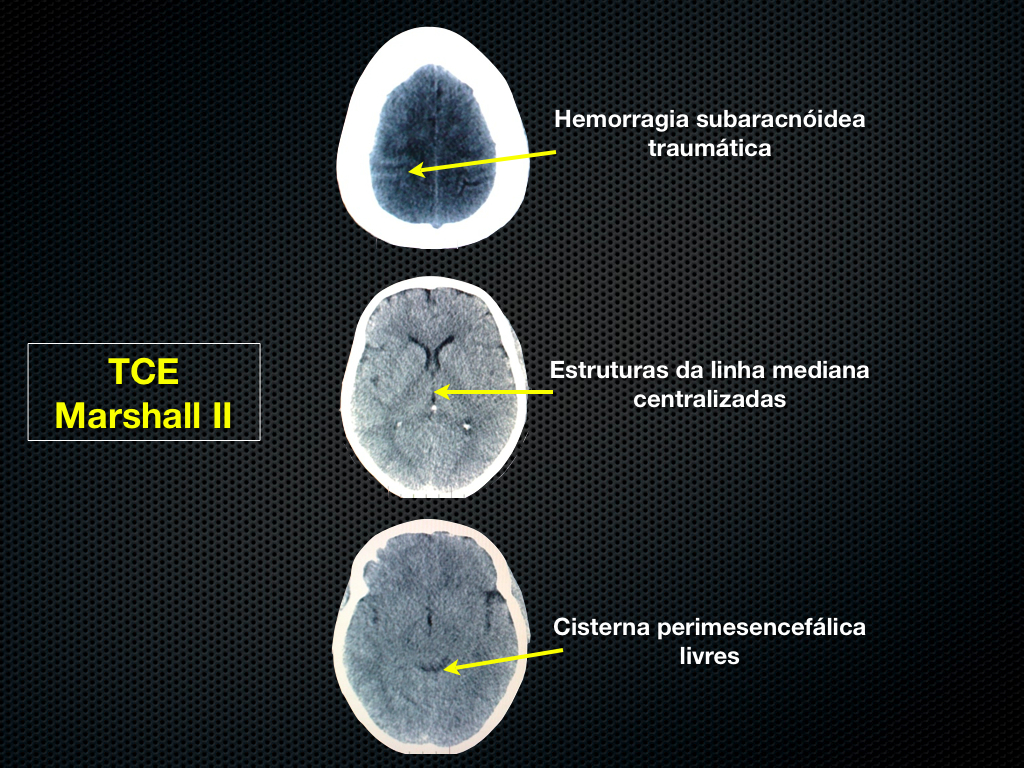 NEUROINTENSIVISMO: Hipertensão Intracraniana no TCE Marshall II