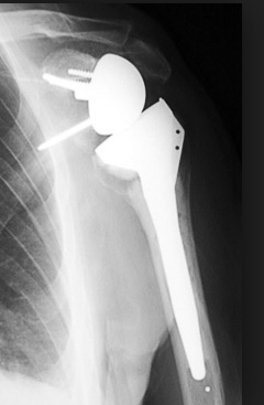 Shoulder Arthritis / Joint Replacement : Avoiding scapular notching in ...