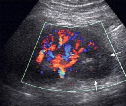 Renal Ultrasound Cases (Adrenal haemorrhage, Perinephric haematoma ...
