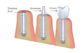 Arizona’s First Choice For Dental Implants: Tooth Implant - A Right ...
