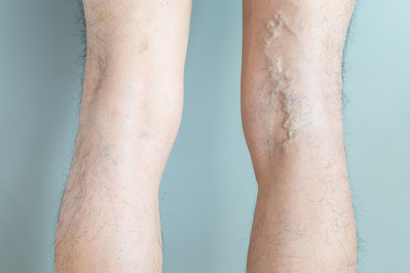 Como Quitar El Dolor de Varices y Prevenir Su Desarrollo - Varices ...