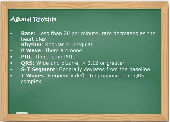 Float Nurse: Basic Rhythm Review: Ventricular Rhythms