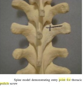 Dr.Sharath's Blog: Thoracic and Lumbar pedicle screw insertion