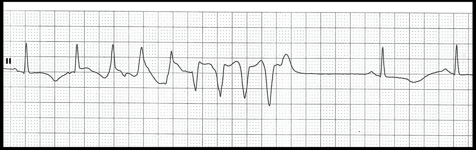 ECG Rhythm Strip Quiz 120