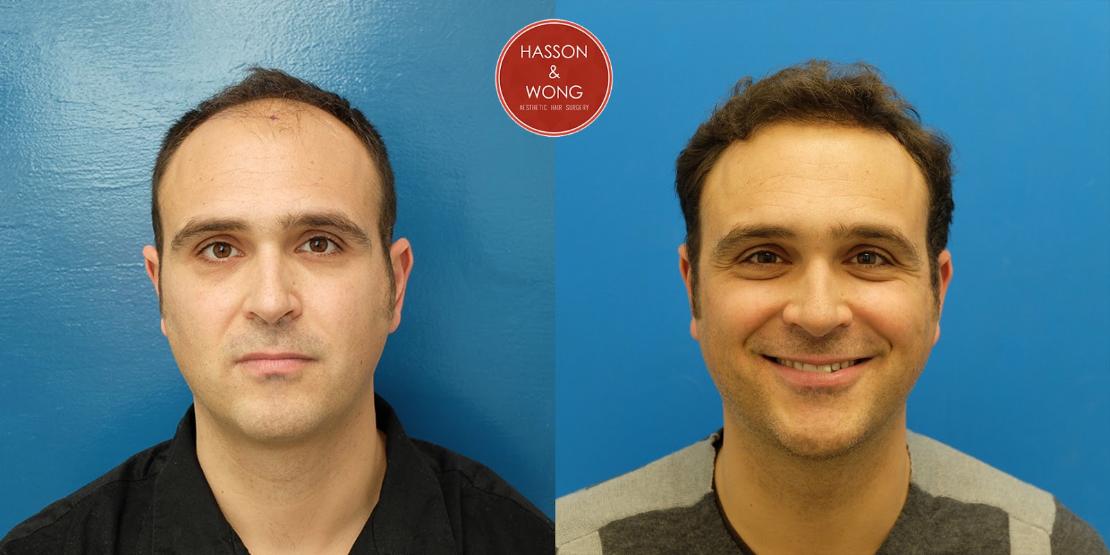 hair solutions: Hasson & Wong Clinic - Sessions: 1 - Grafts Implanted ...