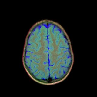 Nevit's blog: Color MRI of the Brain