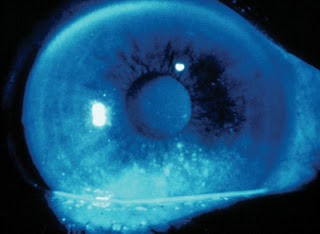 Journal and Conferences on Ophthalmology: Calotropis procera produces ...