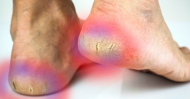 Como Acabar com o Calcanhar Rachado em 7 Dias - Emagrecimento Spa