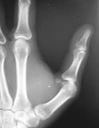 Medical Treatment Pictures-for Better Understanding: Arthroscopic Thumb ...