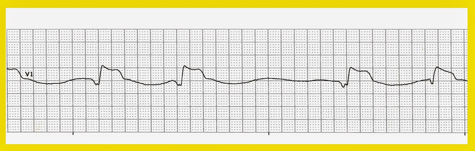 Various Idioventricular Rhythms