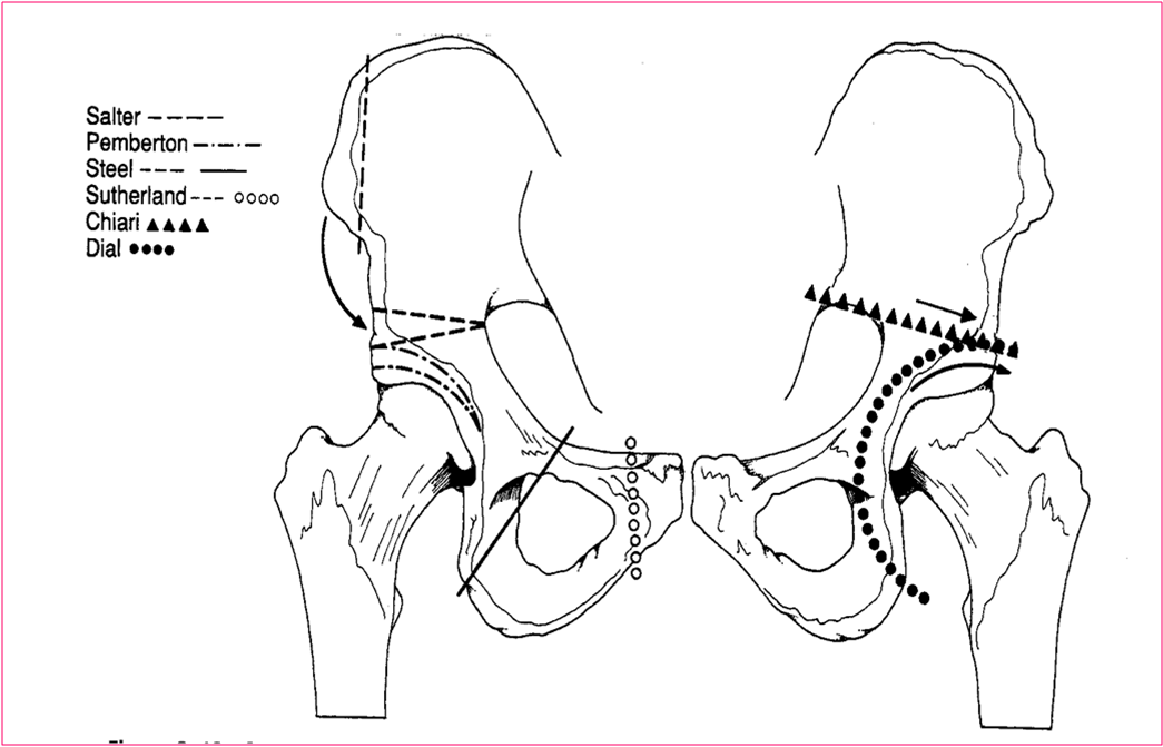 orthopedic chirugus: OSTEOTOMIES AROUND HIP