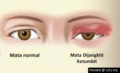 JOM ber"ViTABiSTA": Punca dan Gejala Ketumbit