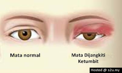 JOM ber"ViTABiSTA": Punca dan Gejala Ketumbit