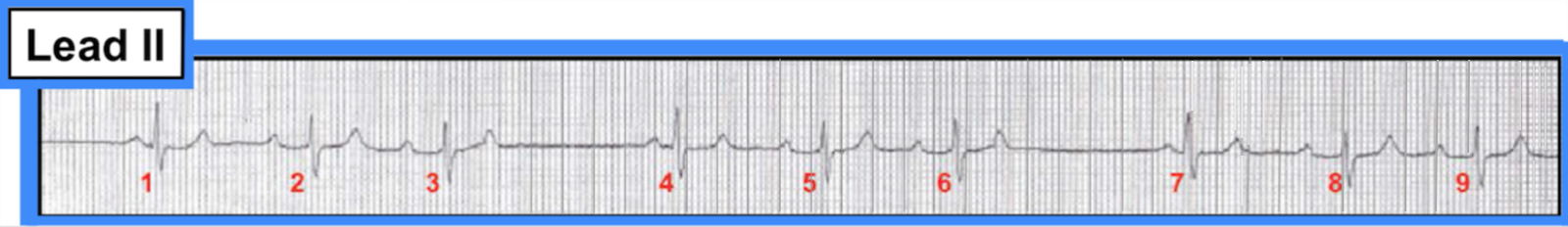 ECG Interpretation: ECG Blog #147 (AV Block - PACs - Mobitz I, II).