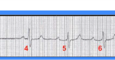 ECG Interpretation: ECG Blog #147 (AV Block - PACs - Mobitz I, II).