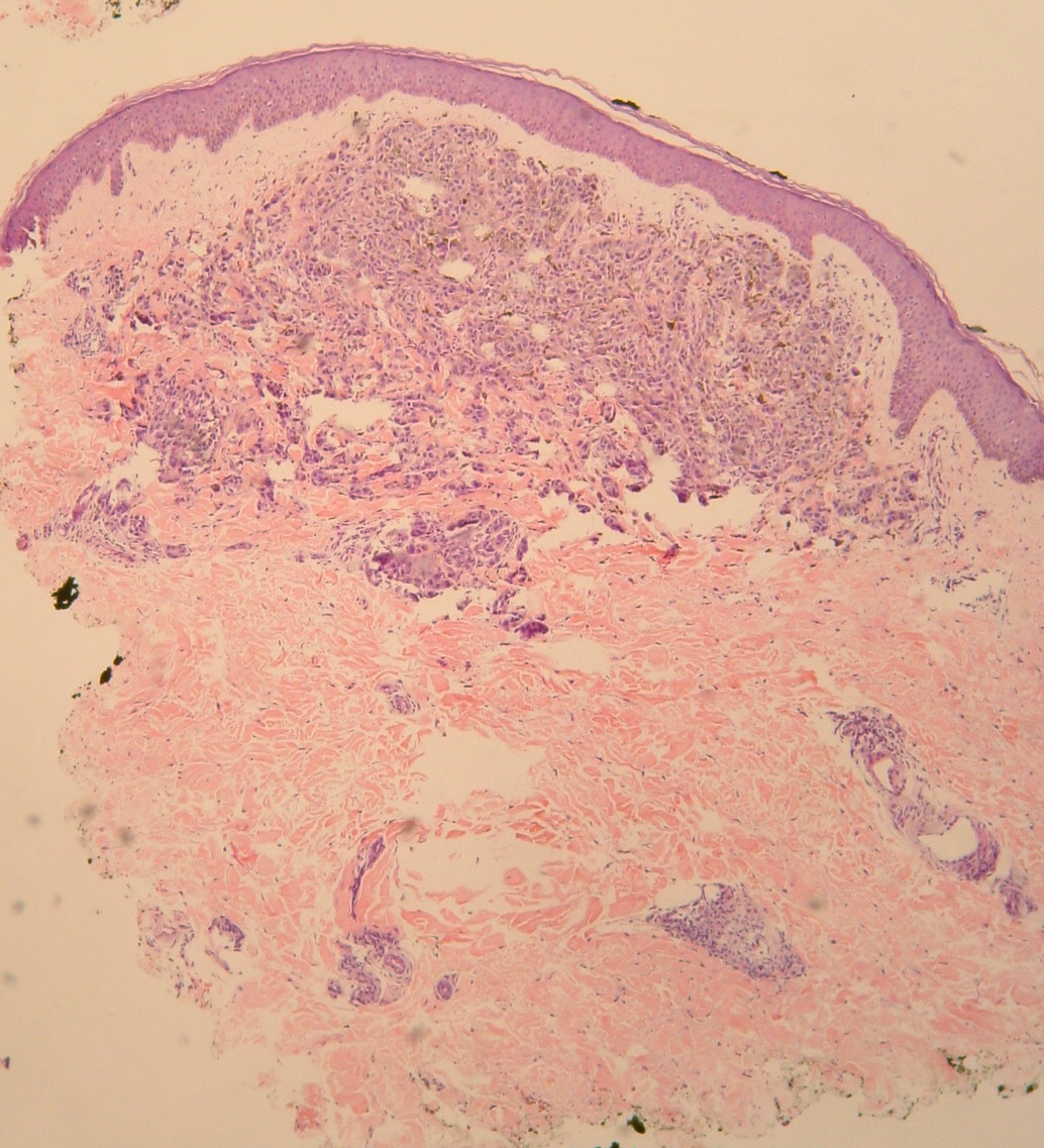 dermatopatologia para iniciantes: MELANOMA