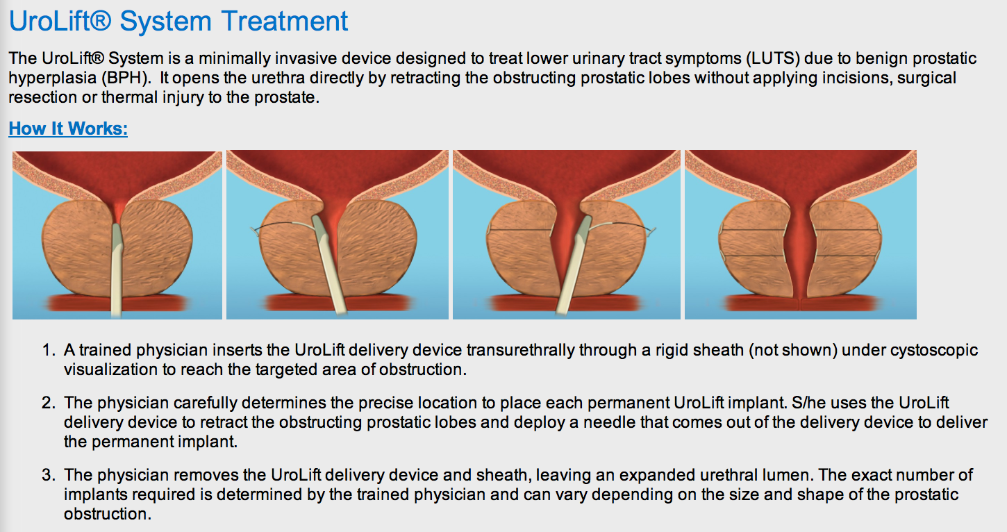 Surgical Opinion Urolift Off The Rewards Associated With Doctors Working Together With Engineers