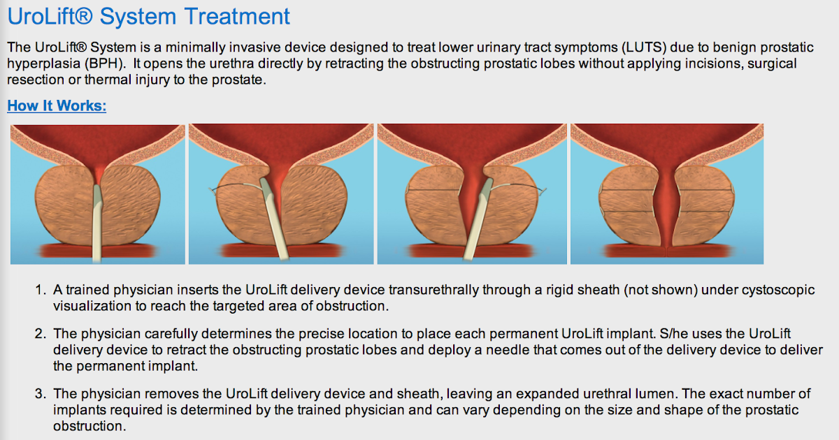 Surgical Opinion: Urolift-off. The rewards associated with Doctors ...