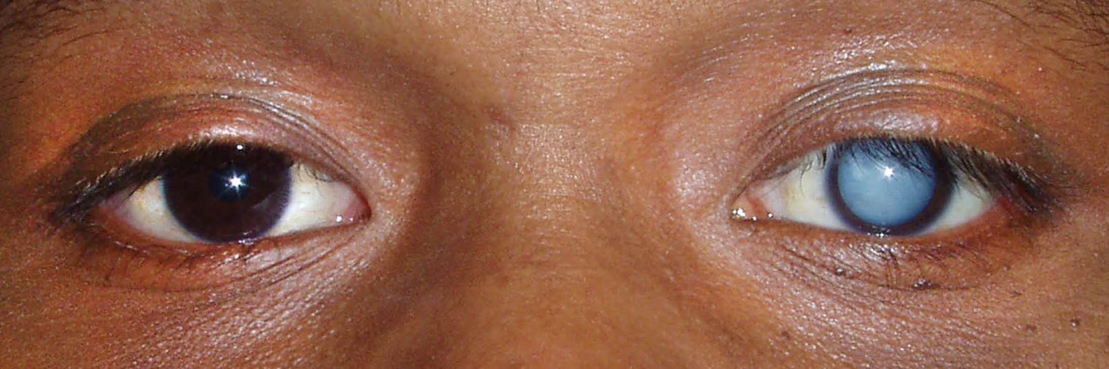 COMMON EYE DISEASES: CATARACT