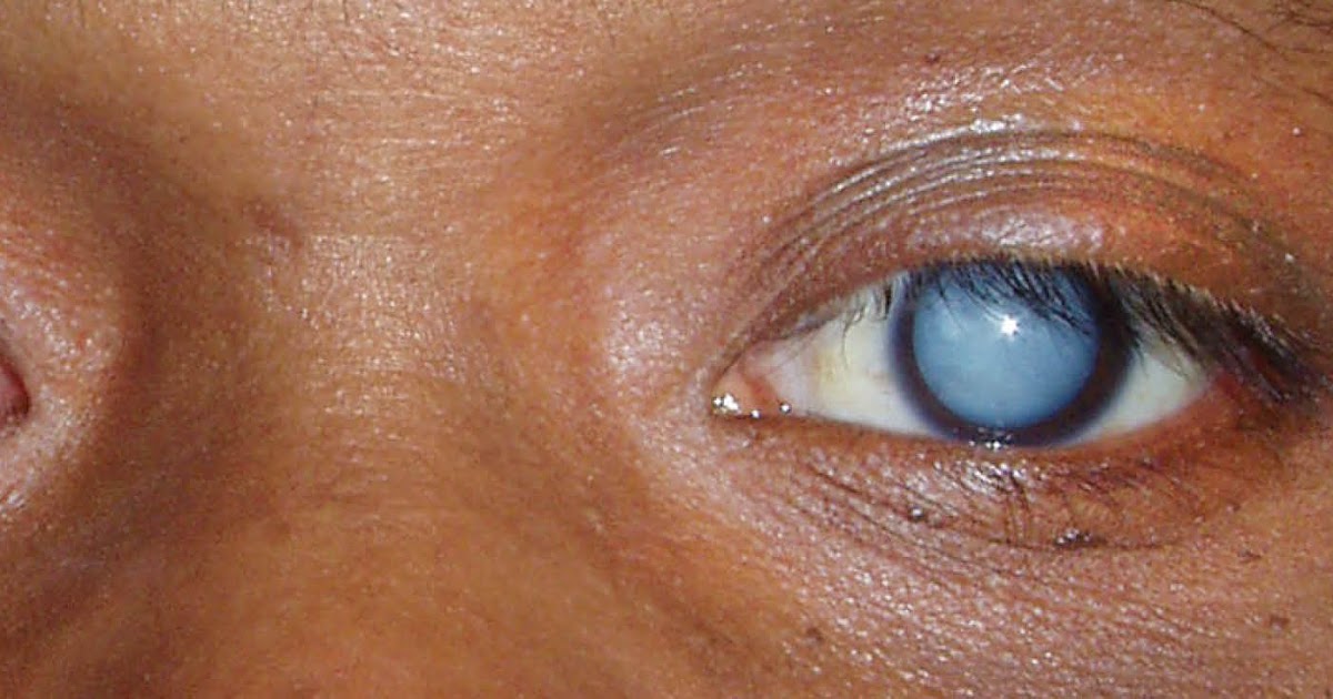 Common Eye Diseases Cataract