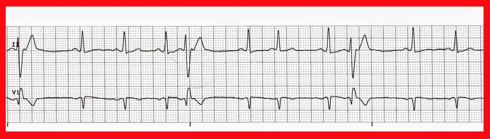 EKG Rhythm Quiz 223