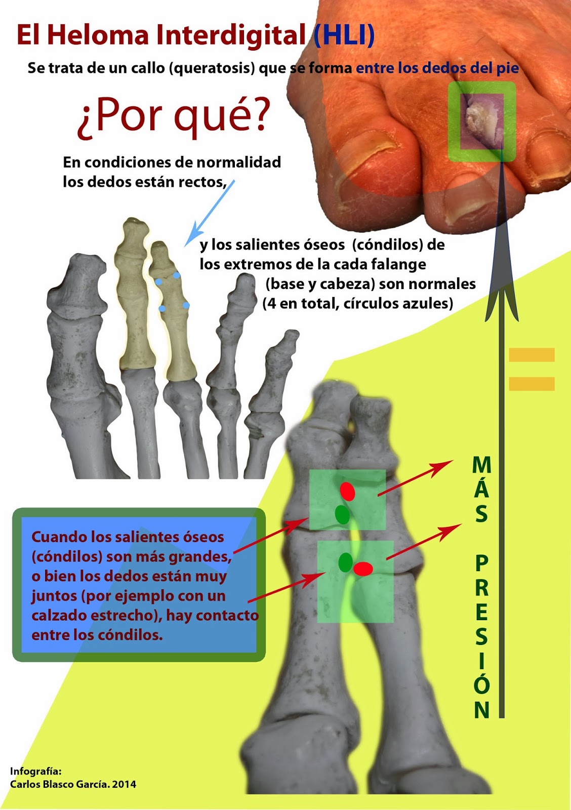 Carlos Blasco García: El Heloma Interdigital (HLI): un motivo para que ...