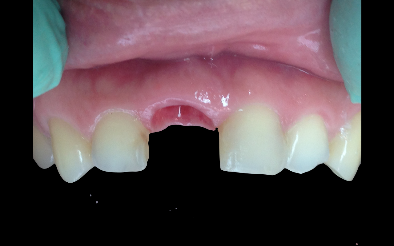 CURSO DE POSTGRADO EN IMPLANTOLOGIA DE ALTA, MEDIANA COMPLEJIDAD Y ...