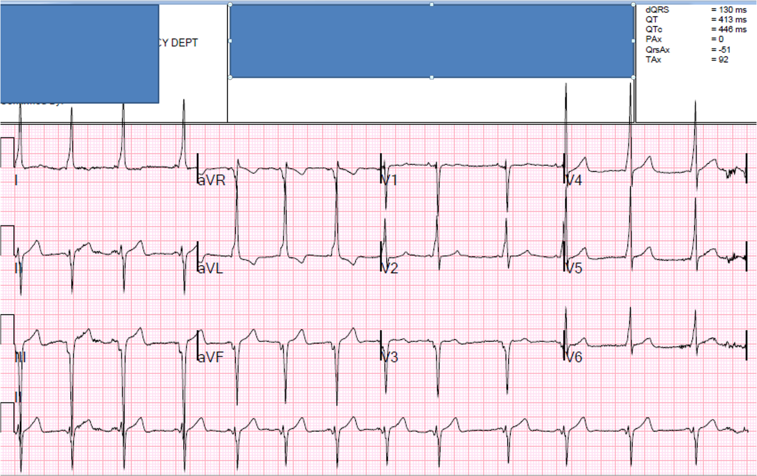 Ivcd rhythm - heavendop