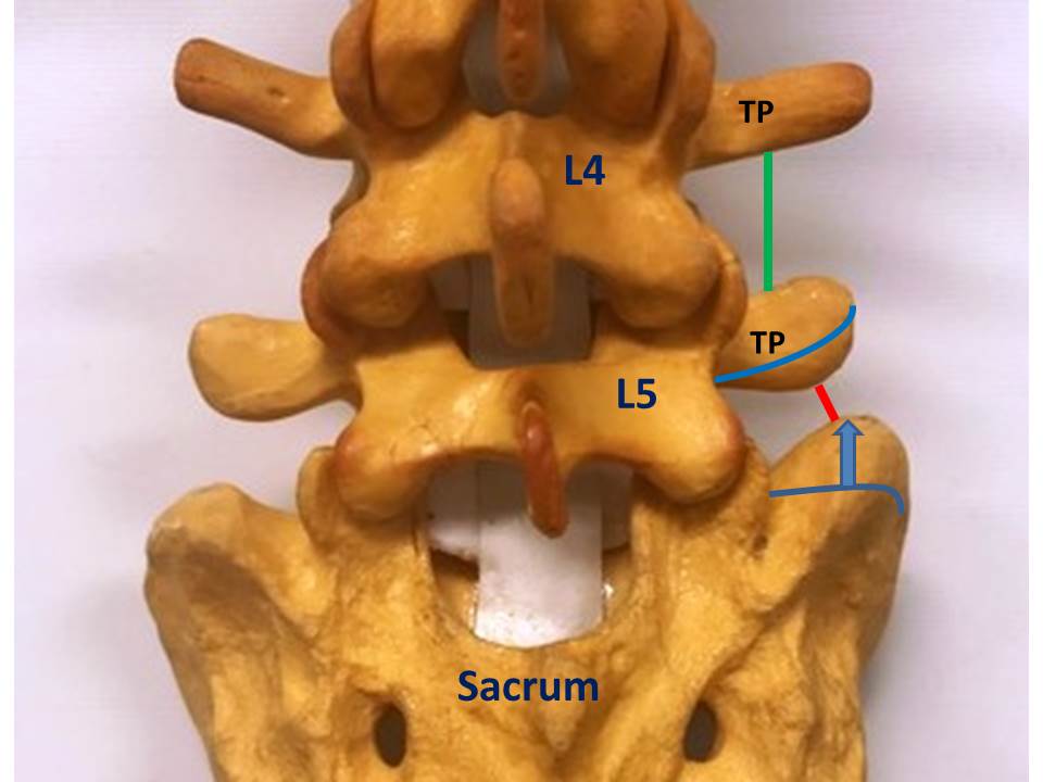 ArthurJenkinsMD: Bertolotti’s Syndrome