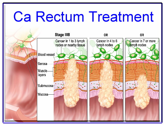 Ca rectum treatment - Sure Developers Team