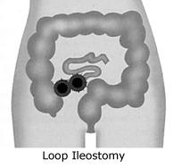 Ileostomy Diagram