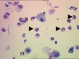 Blog del Laboratorio clinico : Eosinofilos en Moco Nasal