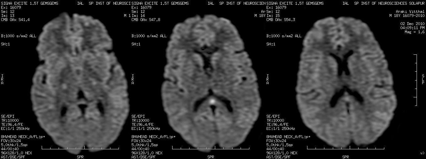Dr Balaji Anvekar FRCR: Restricted diffusion in Splenium of Corpus Callosum